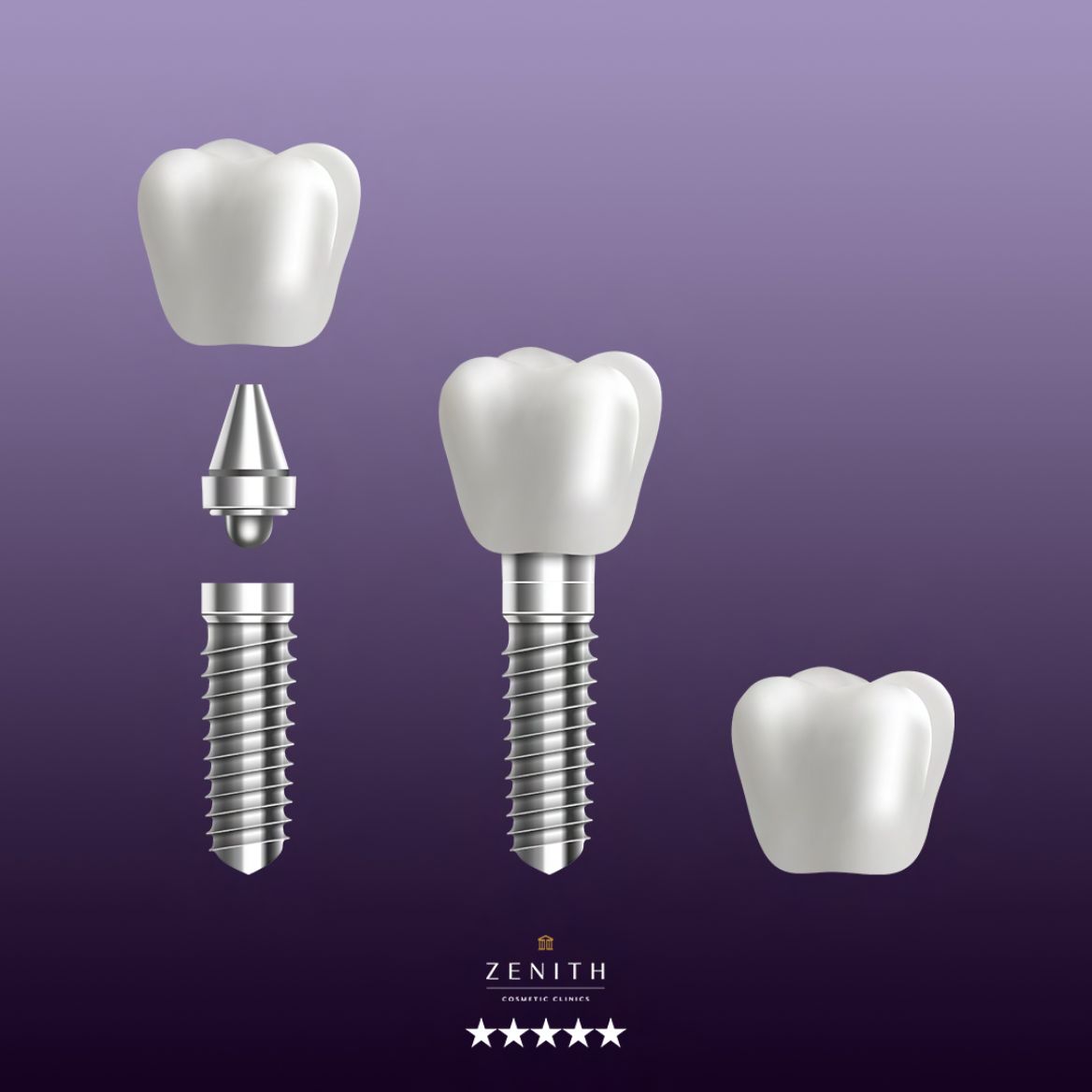 A Zenith Guide to Dental Implants - Zenith Cosmetic Dentistry