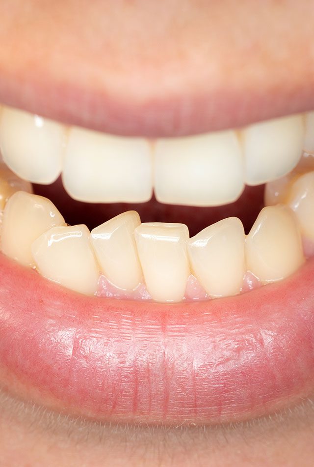Crooked Teeth - Zenith Cosmetic Dentistry