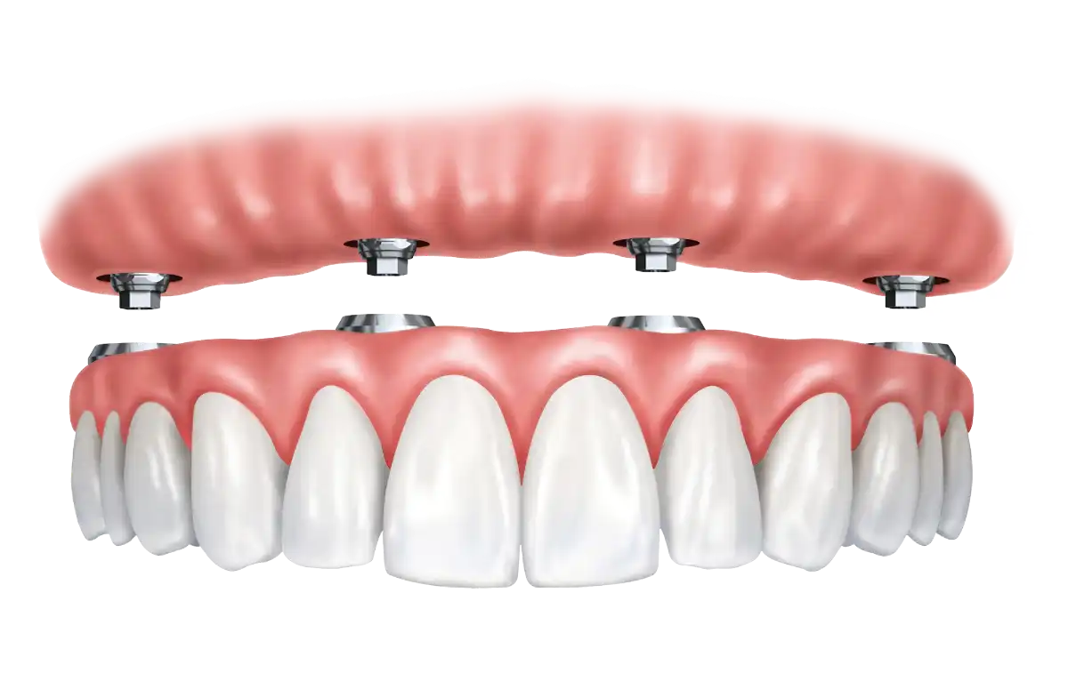 All on 4 Dental Implants – Full Set of Replacement Teeth - Zenith ...